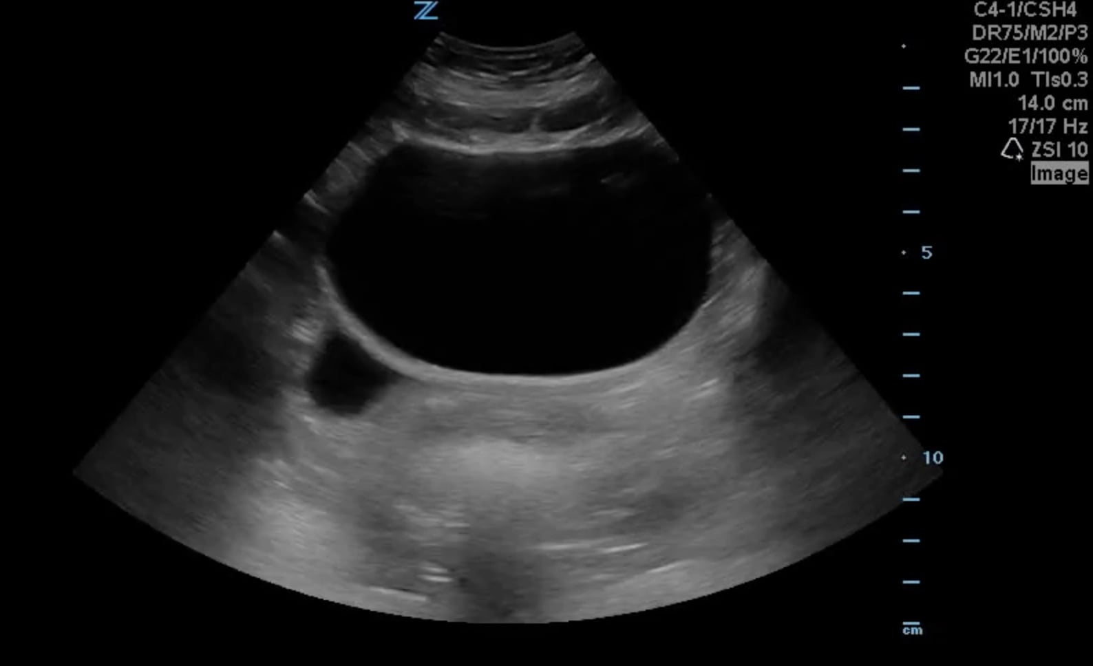 Suprapubic Pain: Clip 3 on Vimeo