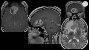 Pterional Craniotomy | The Neurosurgical Atlas