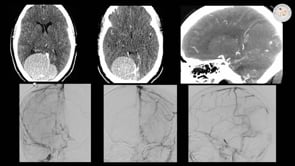 Scalp Incisions | The Neurosurgical Atlas