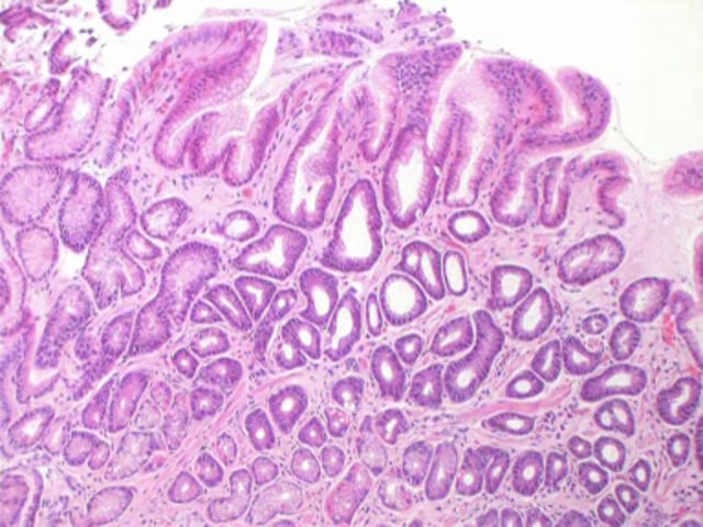 Why do good cells go bad? — Science Learning Hub