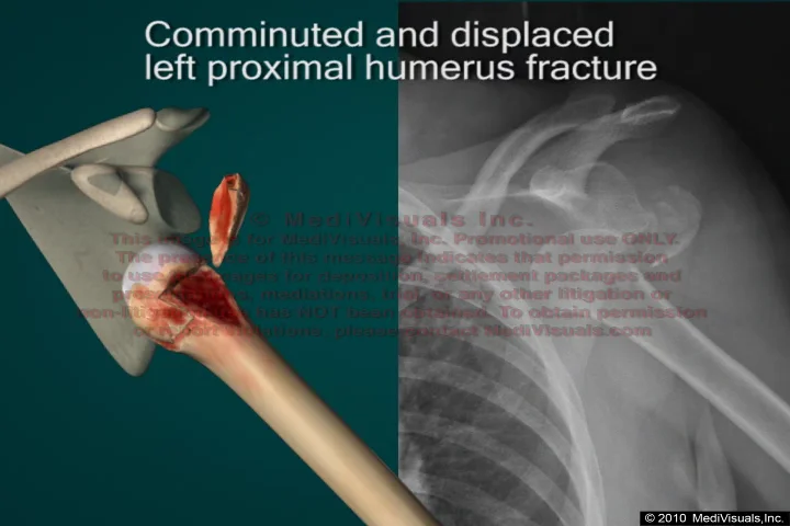 Shoulder Injuries Animation - D19802 on Vimeo