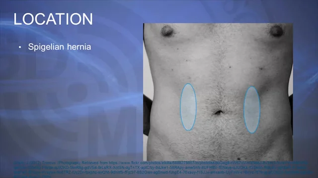 Spigelian Hernia