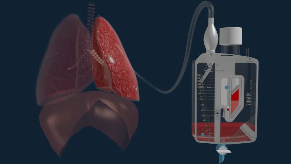 Medical Chest Drain (3D animation): benefits of a dry-seal valve on Vimeo