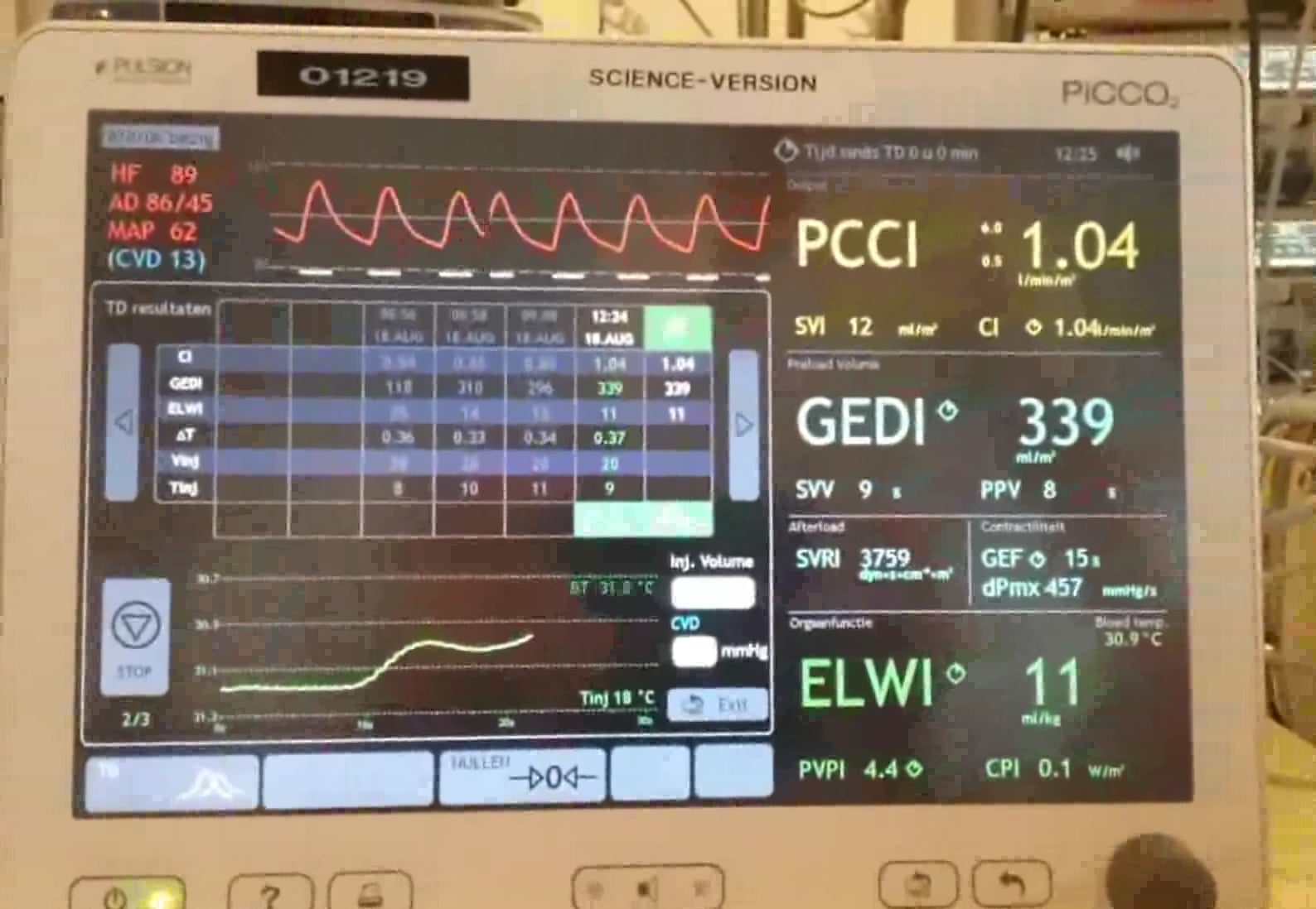 Transpulmonary Thermodilution Curve On Vimeo