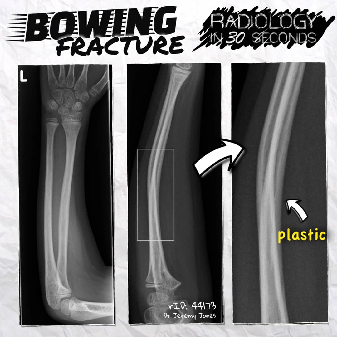 Bowing fracture on Vimeo