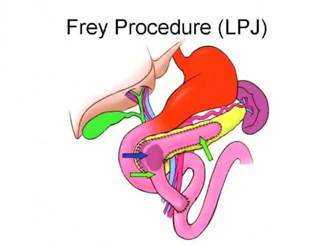 AHPBA Frey Procedure (LPJ) on Vimeo