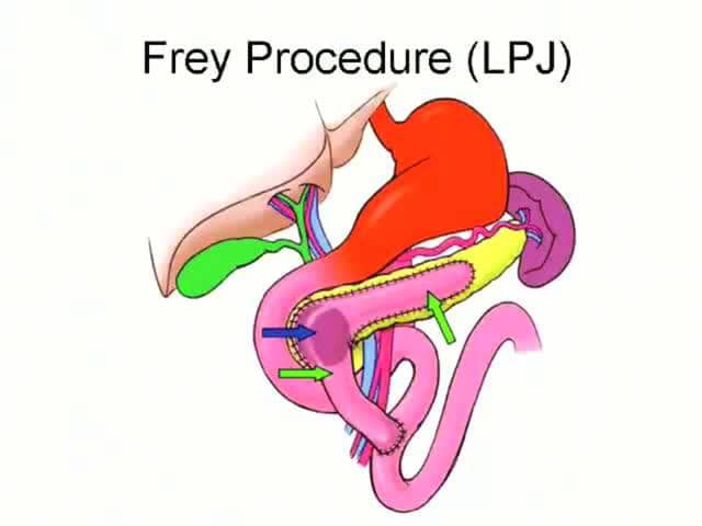 AHPBA Frey Procedure (LPJ) on Vimeo