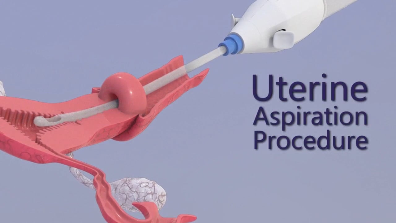 Uterine Aspiration Animated Simulation on Vimeo