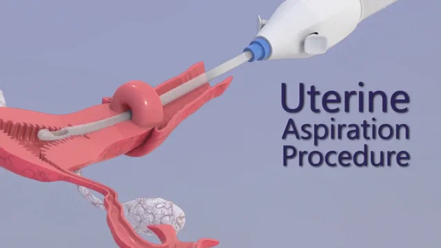 Manual Vacuum Aspiration Abortion