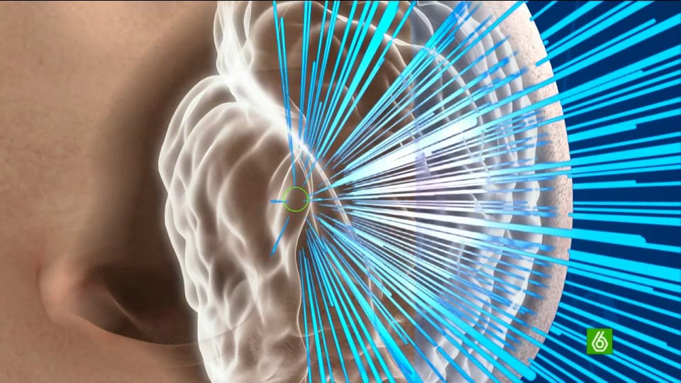 Video reportaje sobre el HIFU en HM CINAC. Entrevista al Dr. Obeso. on ...