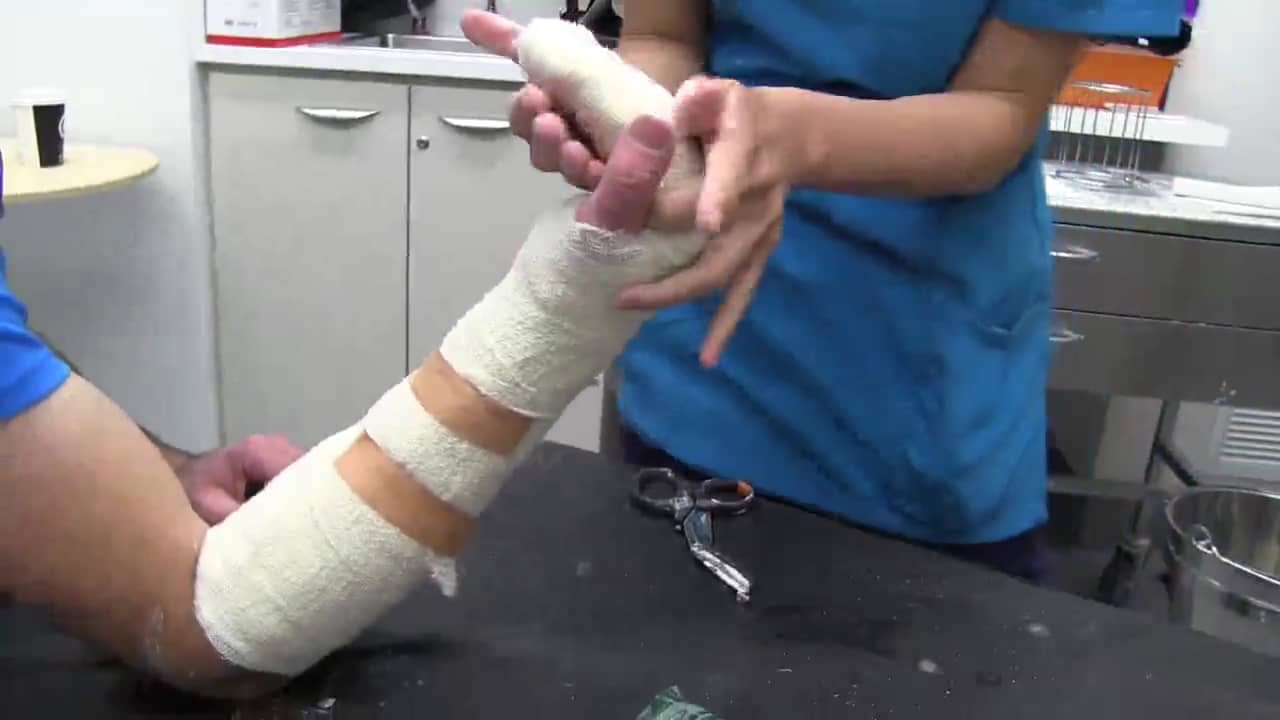 Resting Hand POSI Splint on Vimeo