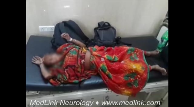 Functional or psychogenic nonepileptic seizures | MedLink Neurology