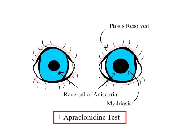 Apraclonidine Test - Horner's Syndrome on Vimeo