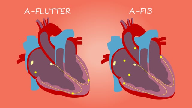 Heart Atrial Fibrillation - Free video on Pixabay
