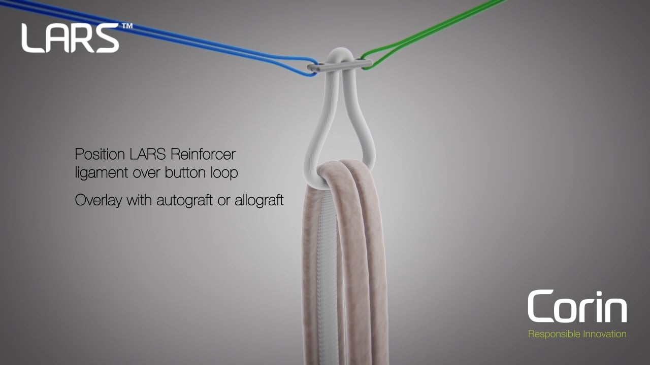 LARS ACL reconstruction using LARS reinforcer on Vimeo