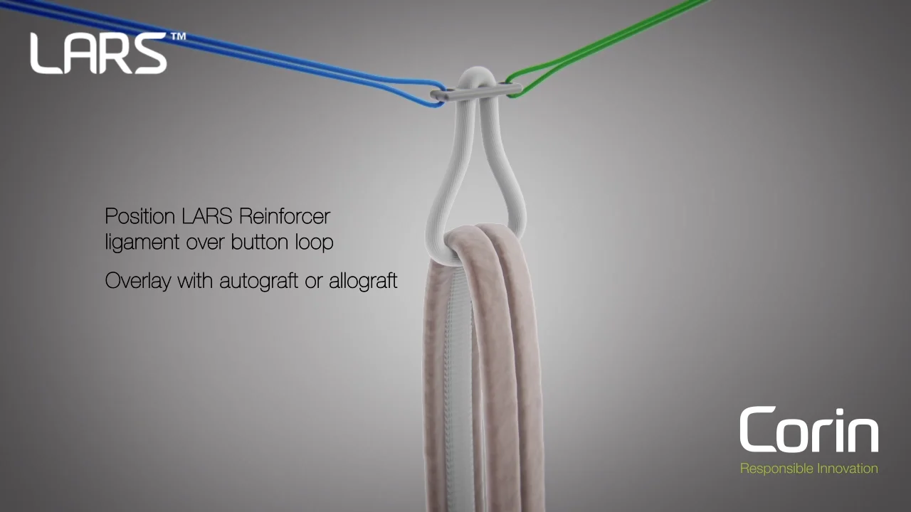 LARS ACL reconstruction using LARS reinforcer