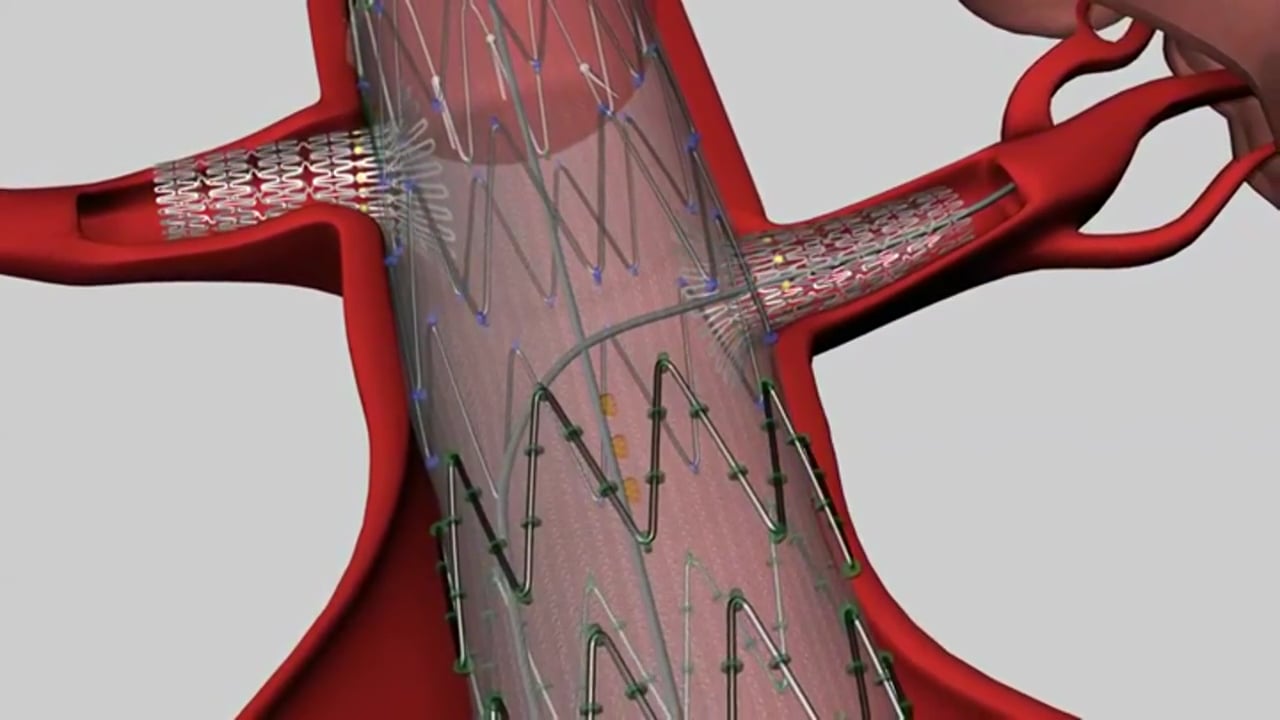 zfen-procedure on Vimeo