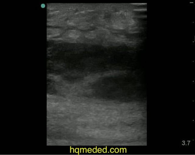 Ultrasonography - Abcess, arm on Vimeo