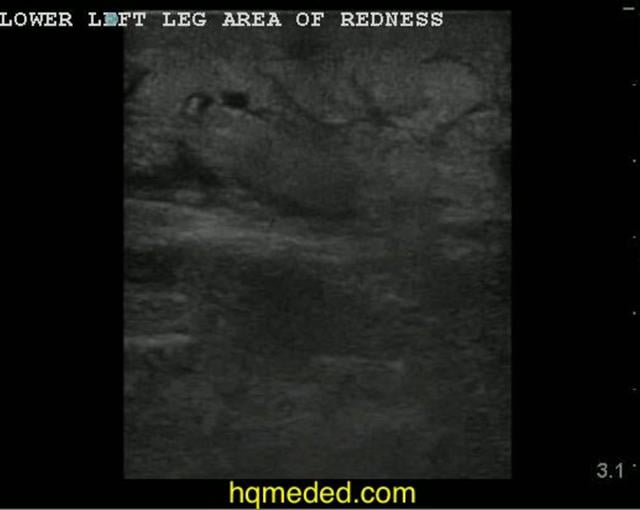 Ultrasonography - cobblestone lower leg on Vimeo