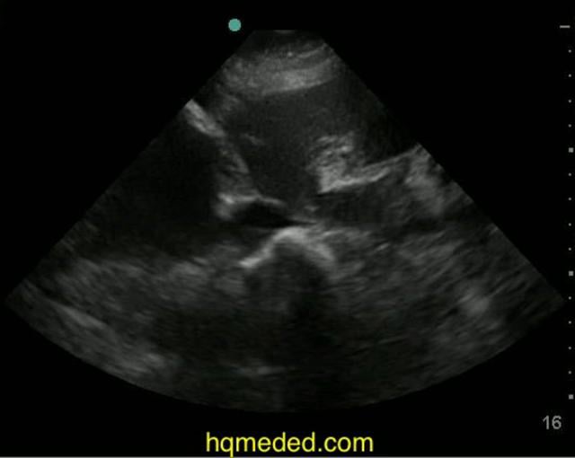 Ultrasonography - collapsed IVC - hypotensive pt on Vimeo