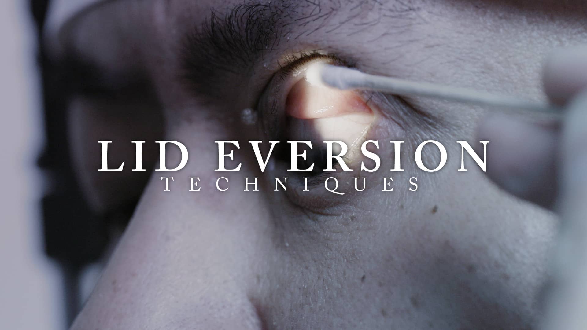 OPHTHALMOLOGY - Video 9 - Lid Eversion on Vimeo