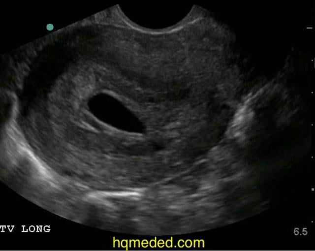 Ultrasonography - blighted ovum on Vimeo