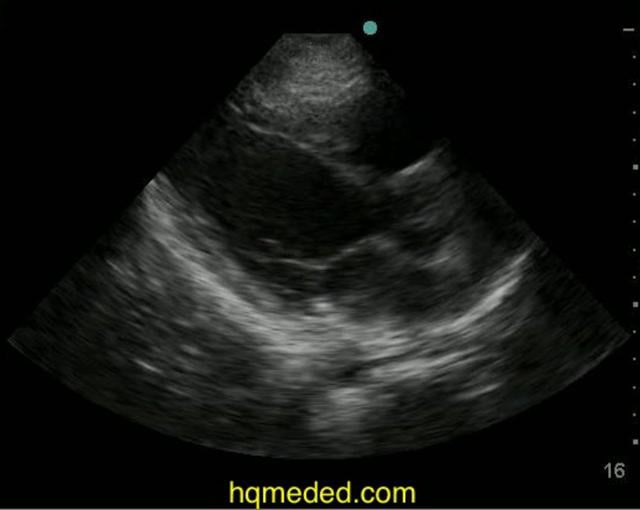 Ultrasonography - grossly normal echo on Vimeo