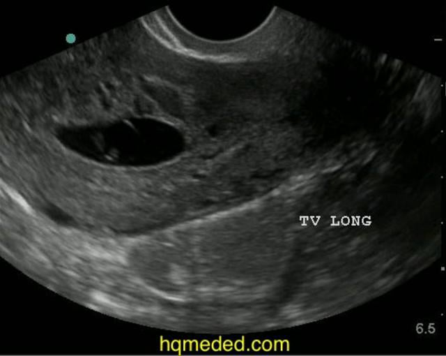 Ultrasonography - IUP on Vimeo