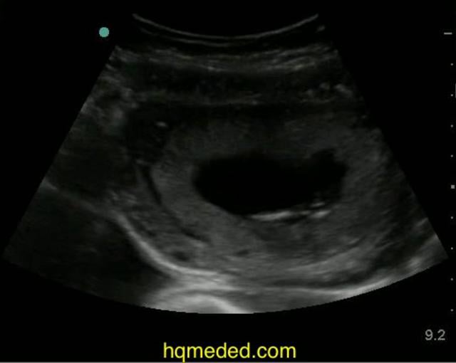 Ultrasonography - IUP on Vimeo