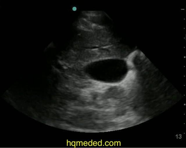 Ultrasonography - normal gallbladder on Vimeo