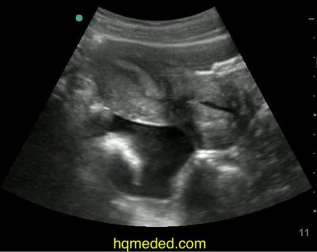 Ultrasonography - positive FAST, splenic laceration on Vimeo