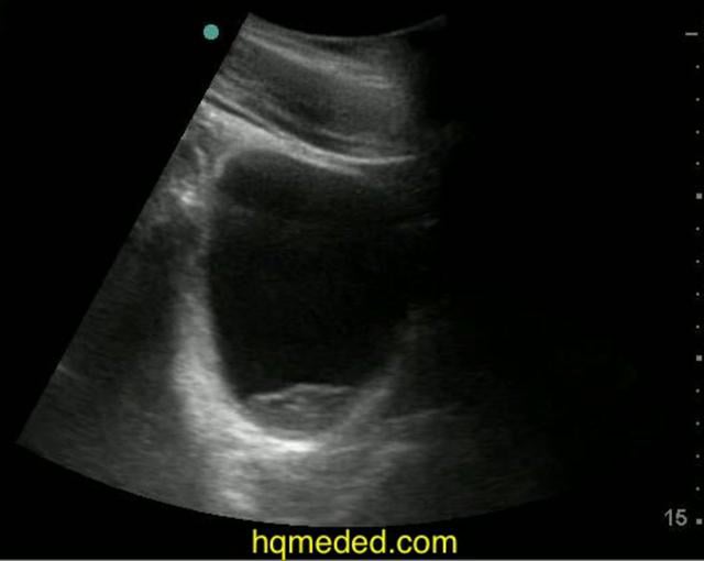 Ultrasonography - sediment in bladder on Vimeo
