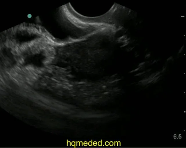 Ultrasonography - very early IUP on Vimeo