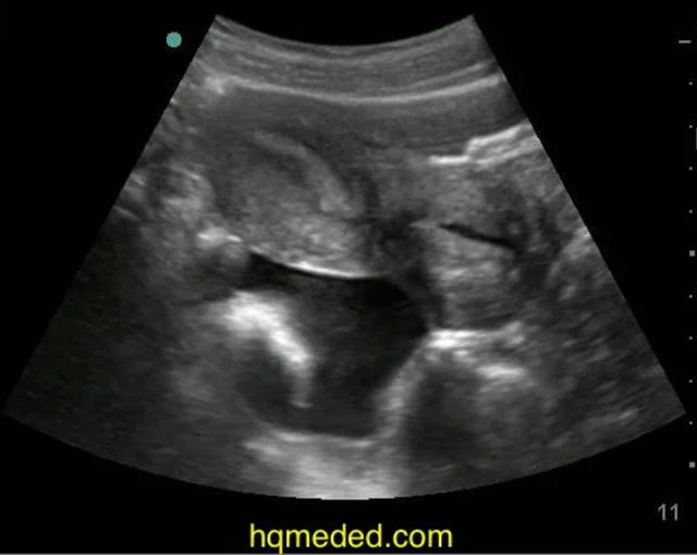 Ultrasonography - positive FAST on Vimeo