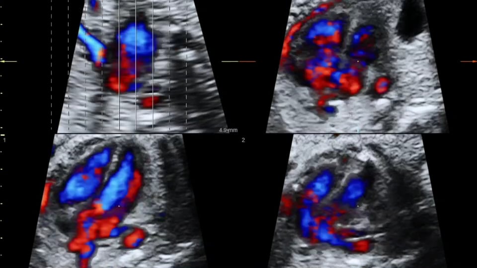 d-transposition of the great arteries (d-TGA), tomographic view on Vimeo