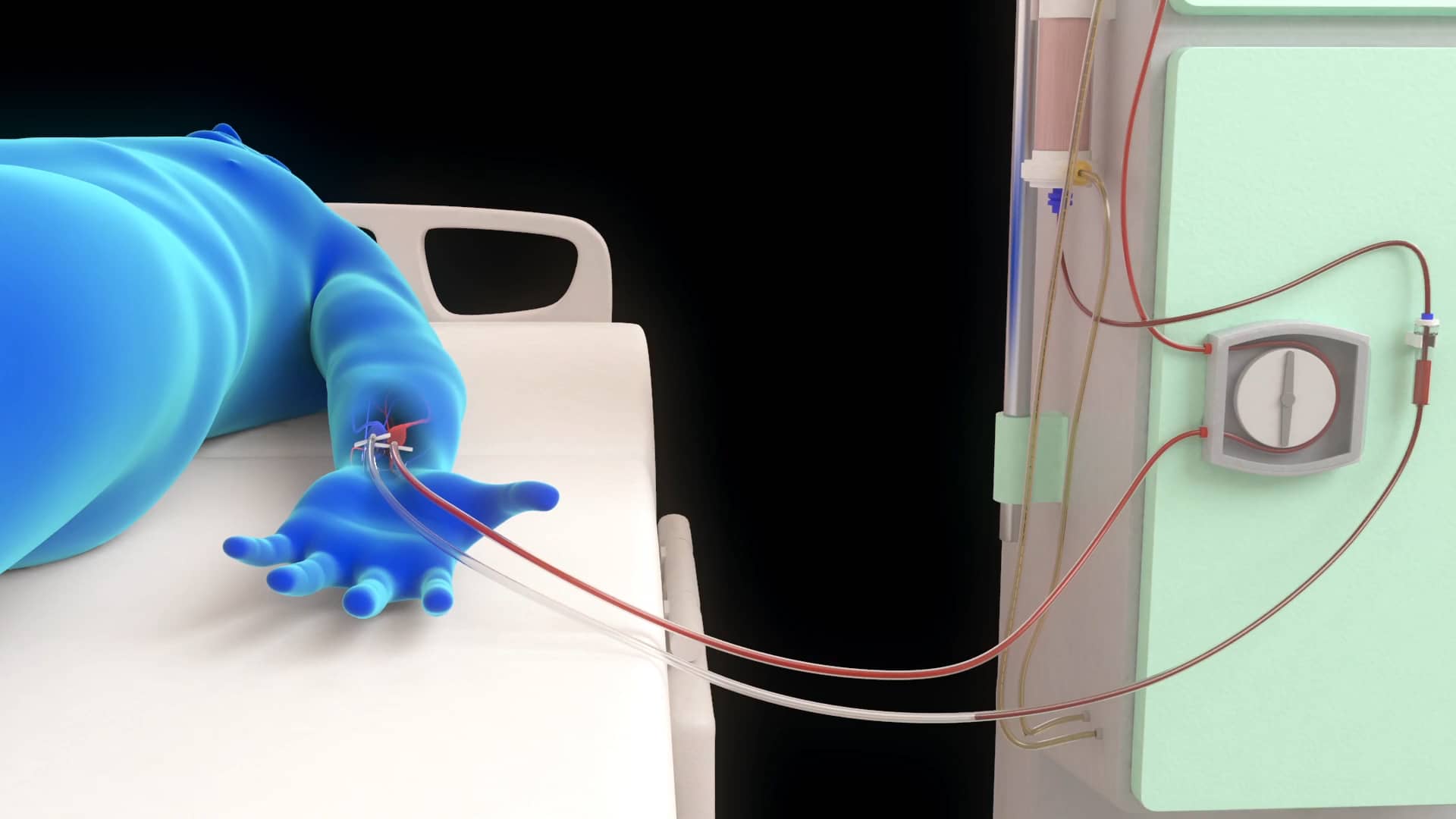 Medical Animation: Hemodialysis on Vimeo