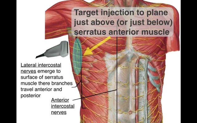 Intercostal Nerve Pain