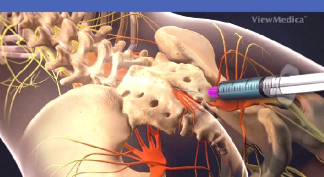 Caudal Epidural Steroid Injection Anatomy