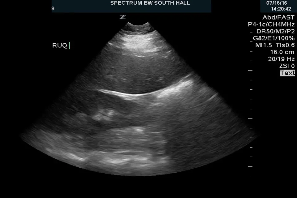 Physiologic Free Fluid Ruq On Vimeo