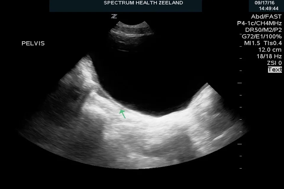 Physiologic Pelvic Free Fluid Pediatric On Vimeo