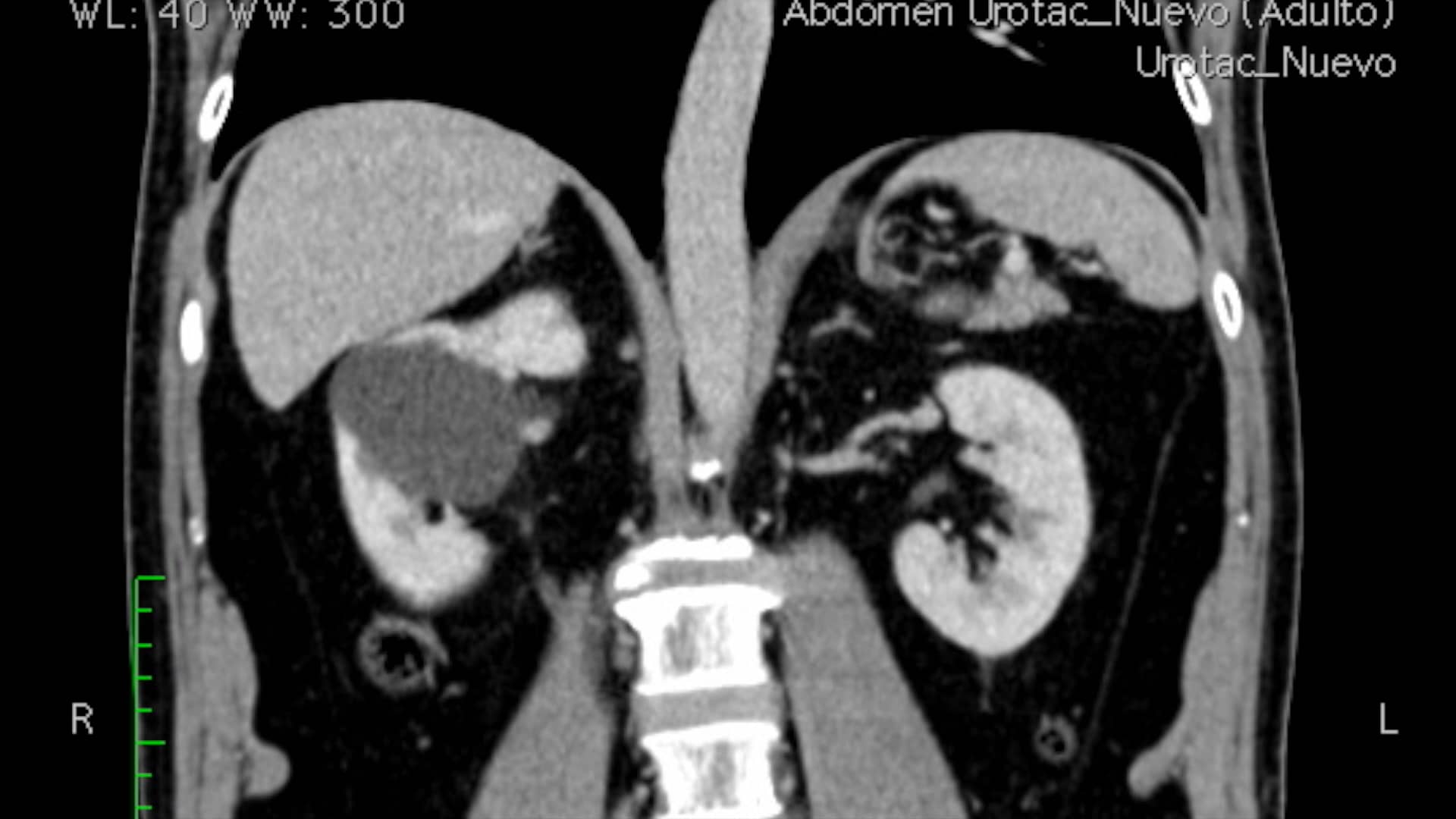 ID 87: MANEJO DE QUISTE RENAL PARAPIELICO OBSTRUCTIVO Y LITIASIS RENAL ...