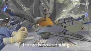 Complex left upper lobectomy with lymphadenectomy by robotic assisted ...