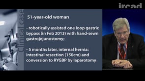 Laparoscopic and endoscopic treatment of a complicated candy cane ...