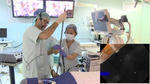 LIVE INTERACTIVE SURGERY: Barrett's esophagus treatment using BARRX ...