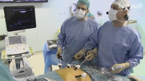 LIVE INTERACTIVE SURGERY: Laparoscopic left lateral sectionectomy for ...