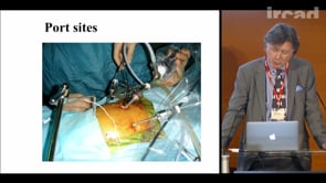 Laparoscopy for choledochal cysts | WebSurg, the online university of IRCAD