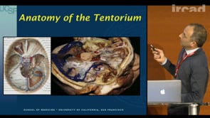 Anterior petrosectomy | WebSurg, the online university of IRCAD