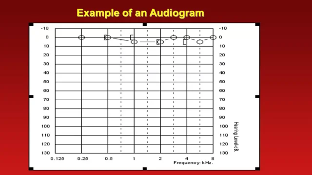 Normal Audiogram