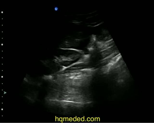 Ultrasonography - intraperitoneal free fluid on Vimeo