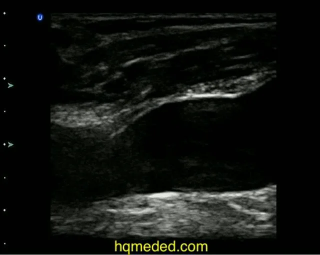 Ultrasonography - longitudinal central line on Vimeo
